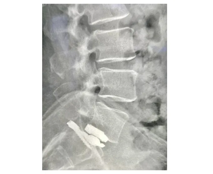 Dr. Todd Lanman Begins Breakthrough Low Back Total Joint Replacement ...